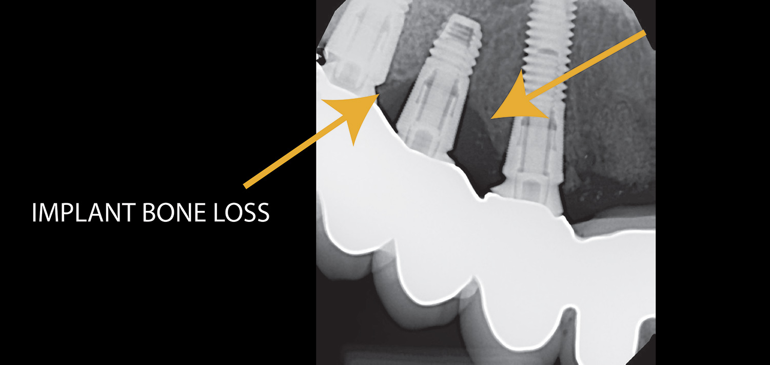 Can you Still Have Dental Implants if You Have Severe Bone Loss? Can you Still Have Dental Implants if You Have Severe Bone Loss?
