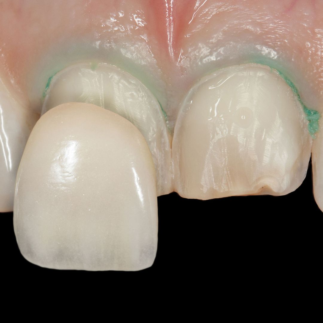 Do You Need to Shave Your Teeth for Veneers?
