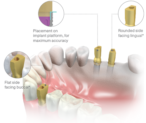 MIS Digital Restoration: Single Tooth > Implant Level