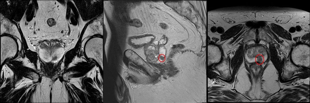 MRT-Fusionsbiopsie | Prostatakarzinom