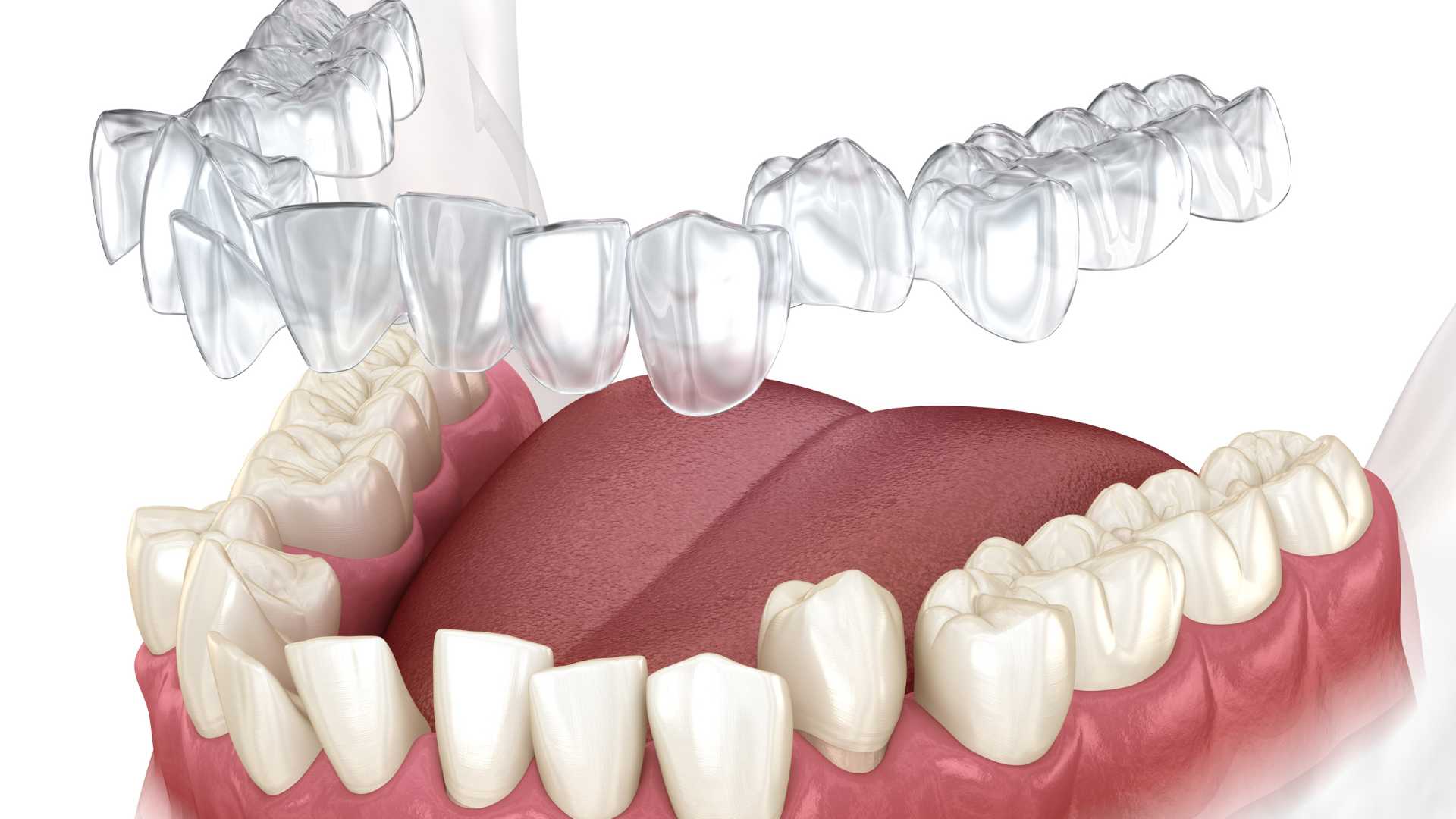 How to Pick Your Invisalign Provider: Factors to Consider