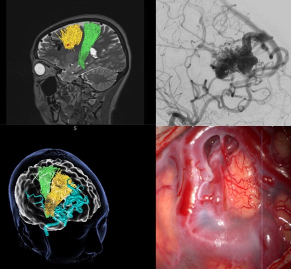 Surgical Treatment of Brain AVM
