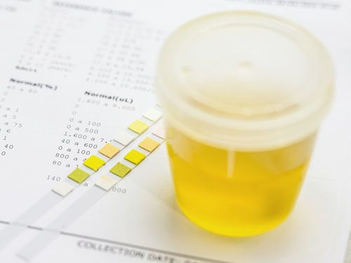 How to read a urine dipstick test to detect a Urinary Tract Infection (UTI)