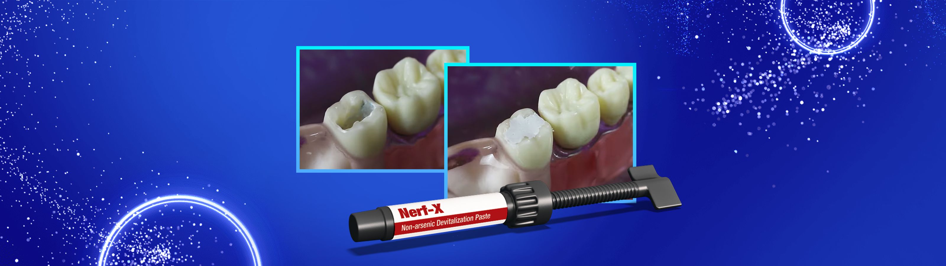 DSI Nerf-X Paste Devitalization | DSI Dental Solutions