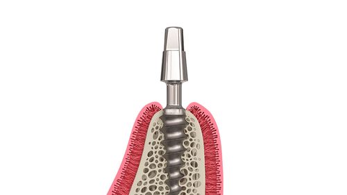 DSI Compressive Implant | Discover Dental Products & Solutions