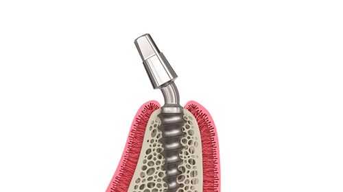 DSI Compressive Implant | Discover Dental Products & Solutions