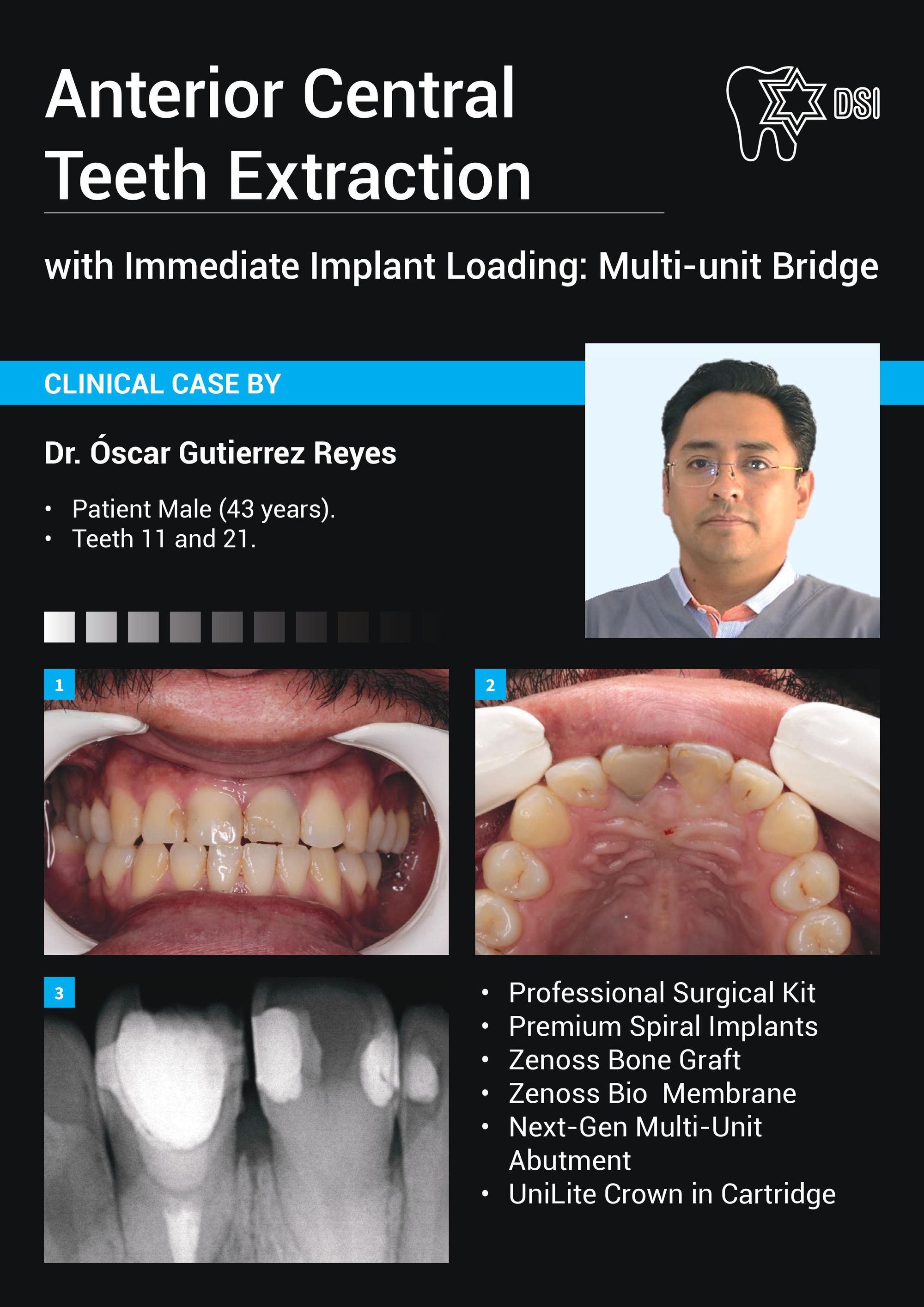 Case Study: Anterior Central Teeth Extraction with Immediate Implant ...