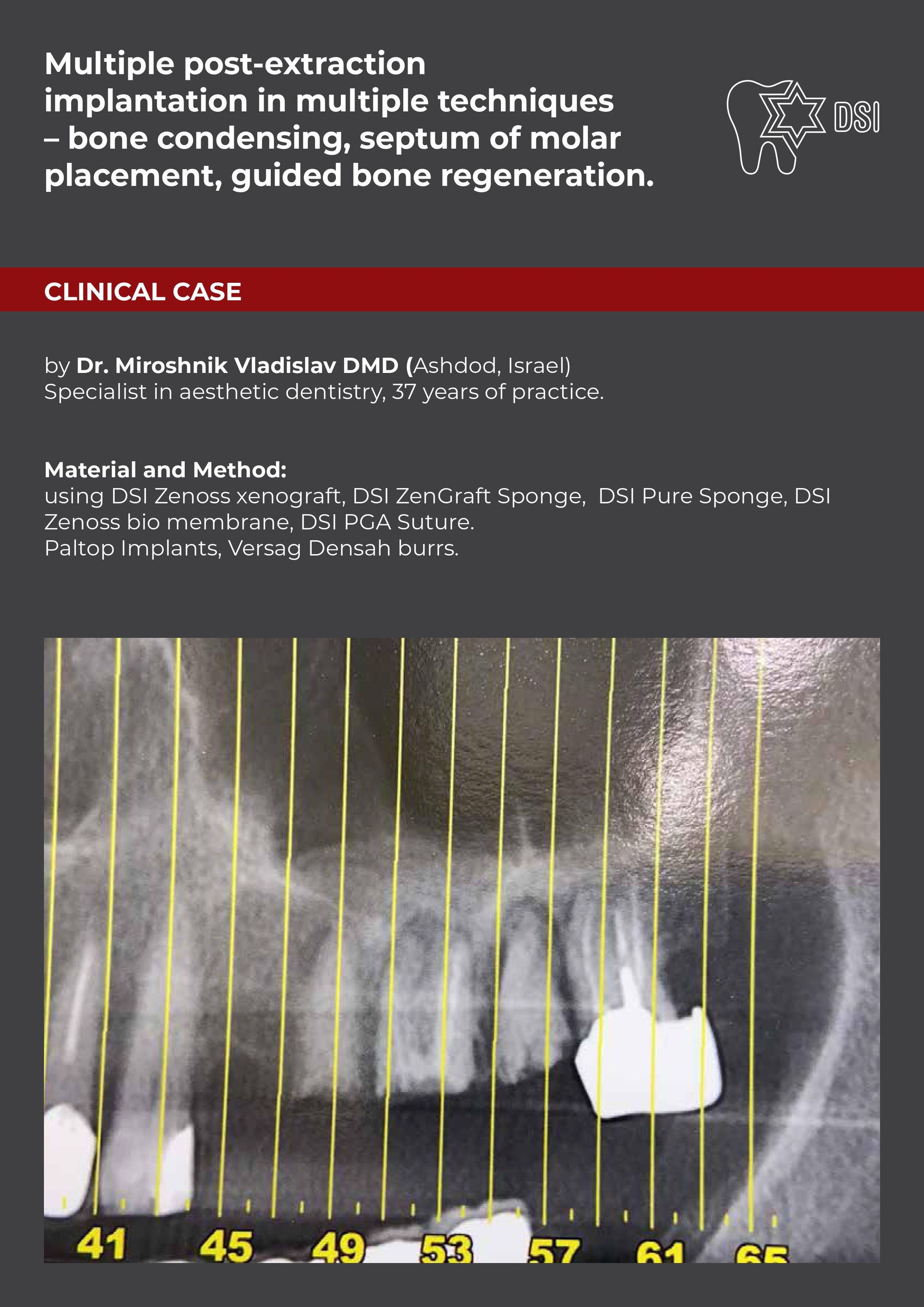 Case Study: Multiple post-extraction implantation in multiple ...