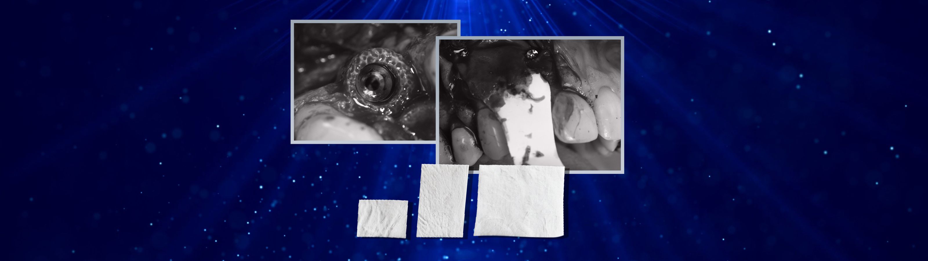 Fistula treatment and tooth replacement using bone ring technique