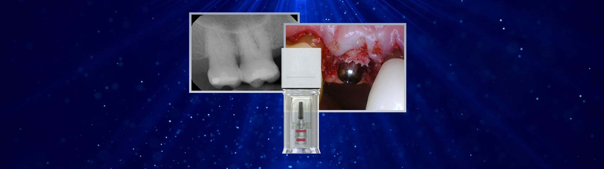 Case Study: Classic Implant surgery integration in a short time | DSI