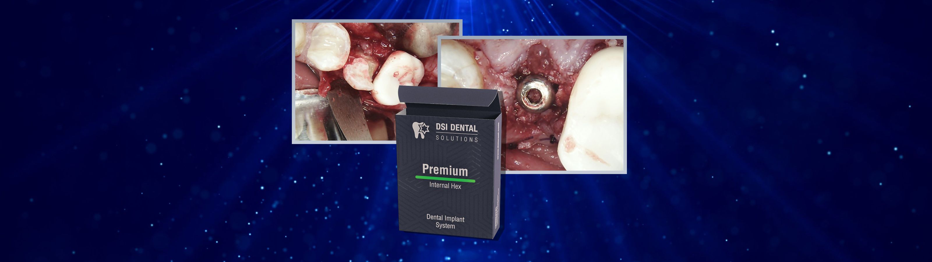 Case Study: Practical case with DSI Premium Spiral Implant | DSI
