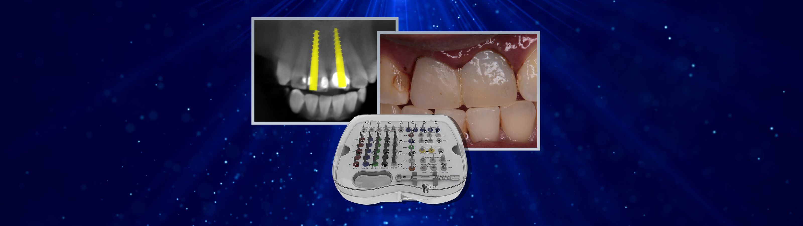 Case Study: Anterior Central Teeth Extraction with Immediate Implant ...