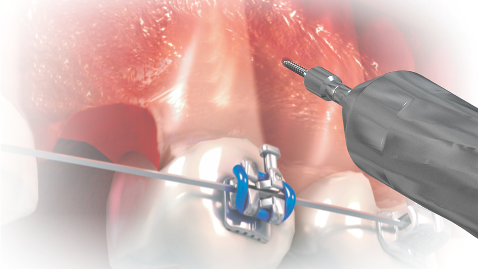 DSI DSI TAD Miniscrew | Discover Dental Products & Solutions