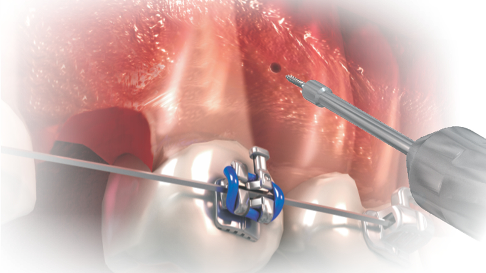 DSI TAD Miniscrew orthodontic implants for teeth alignment