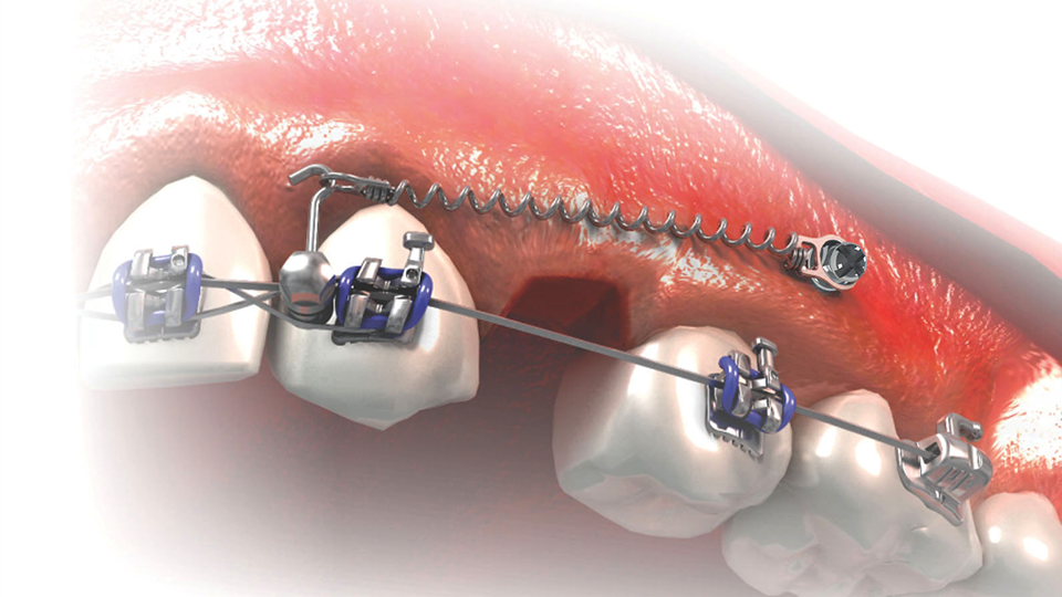 DSI DSI TAD Miniscrew | Discover Dental Products & Solutions