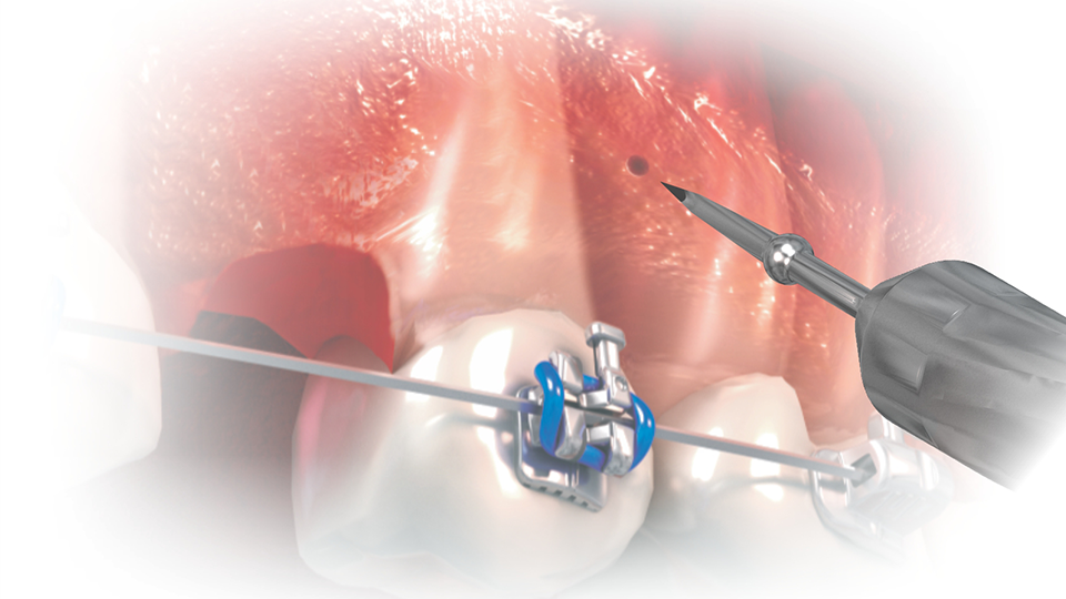 DSI DSI TAD Miniscrew | Discover Dental Products & Solutions