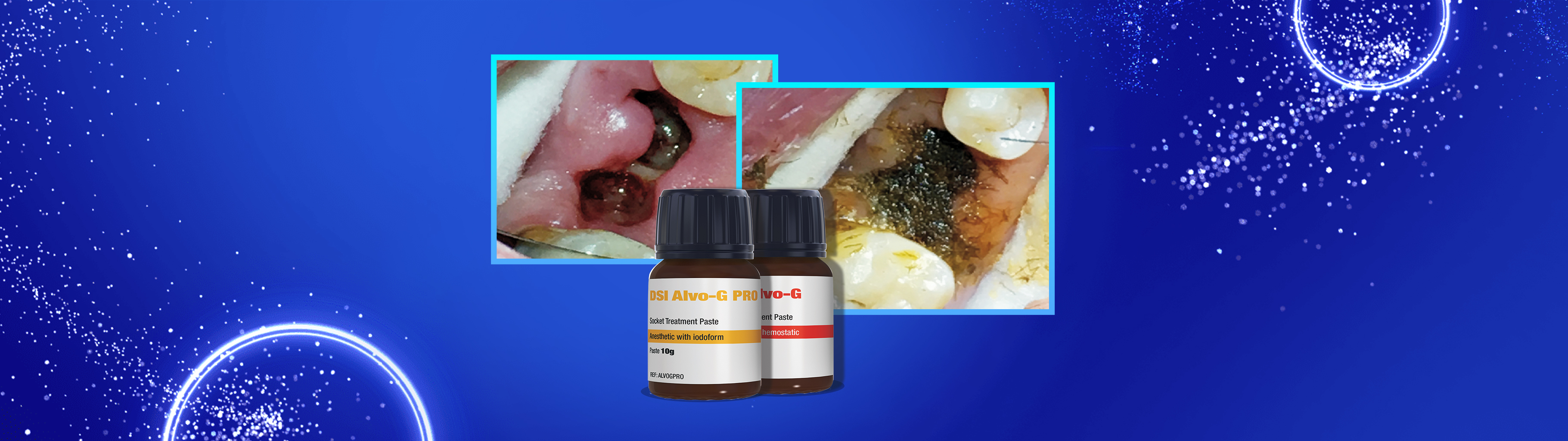 DSI Alvo-G Paste Post-Extraction | DSI Dental Solutions