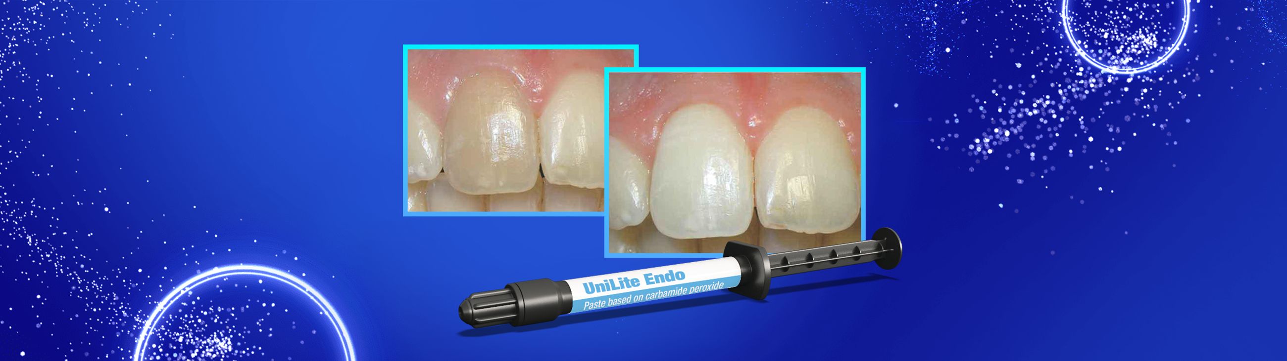 DSI Unilite Endo Whitening Paste | DSI Dental Solutions
