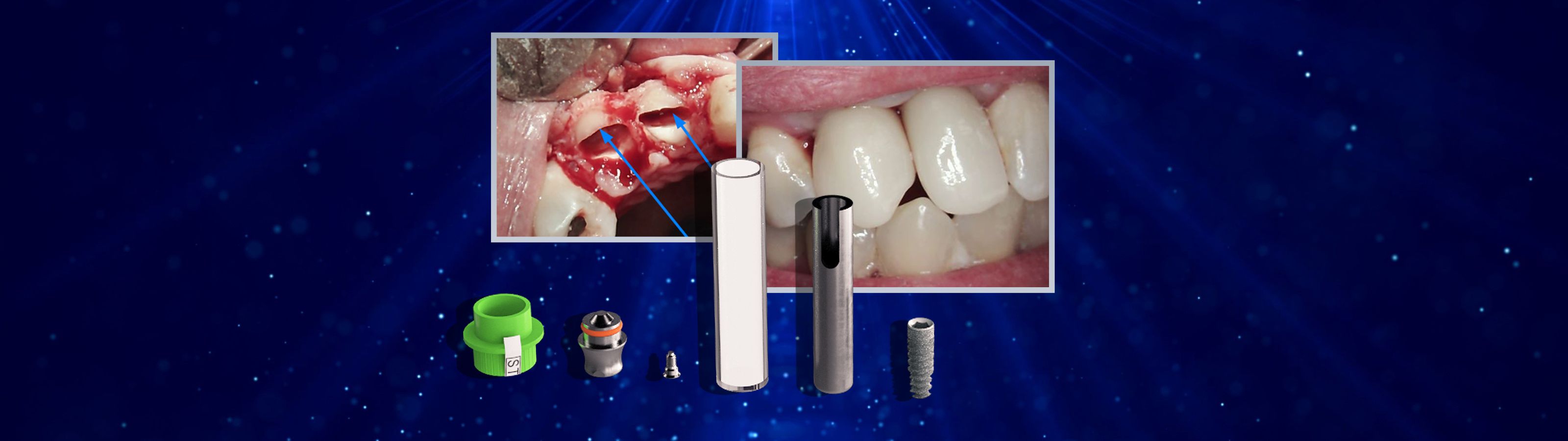 Case Study: Root Shield Technique in Implant Placement | DSI