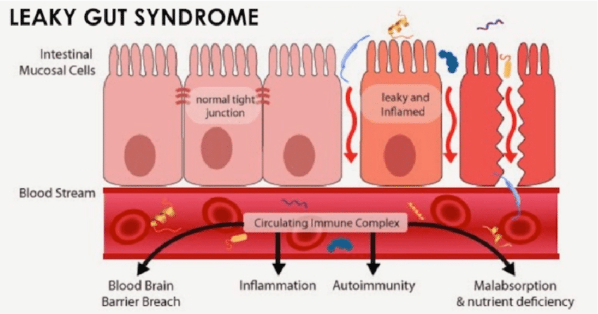 Eczema & Leaky Gut: What You Need To Know