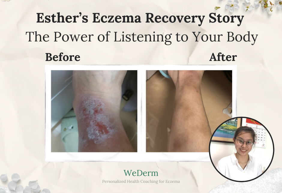 Highschooler Esther’s Eczema Recovery: Listen to Your Body