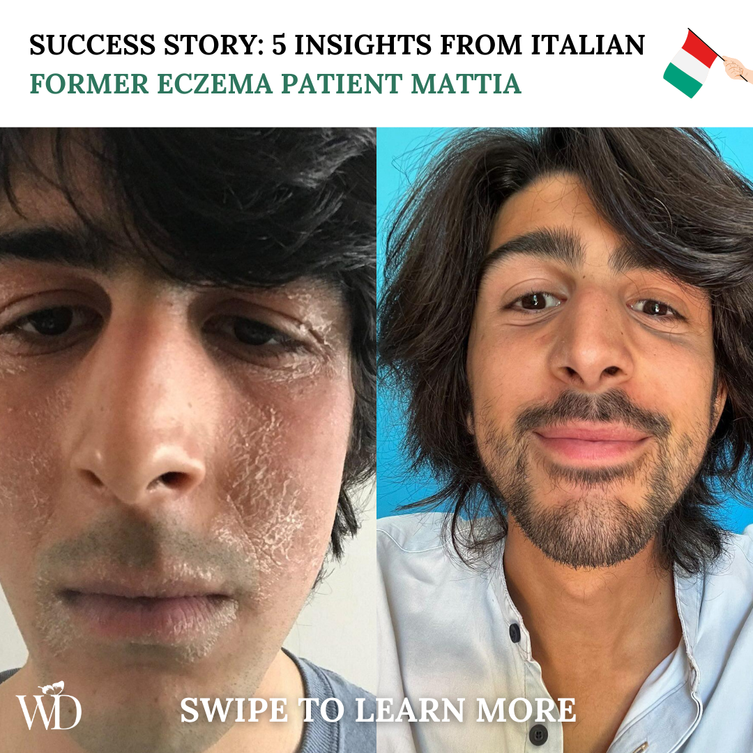 Success Story: 5 Insights From Italian Ex-Eczema Patient Mattia