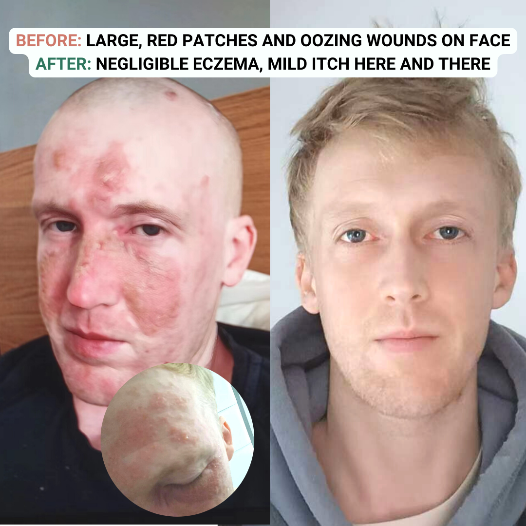 Success Story: How Teacher Peter Overcame Worst Nightmare Facial Eczema