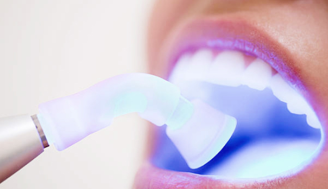 Dental Filling in Thornhill | Orchid Tooth Dental 蘭牙齒科