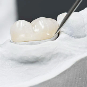 Dental Crown in Thornhill | Orchid Tooth Dental 蘭牙齒科