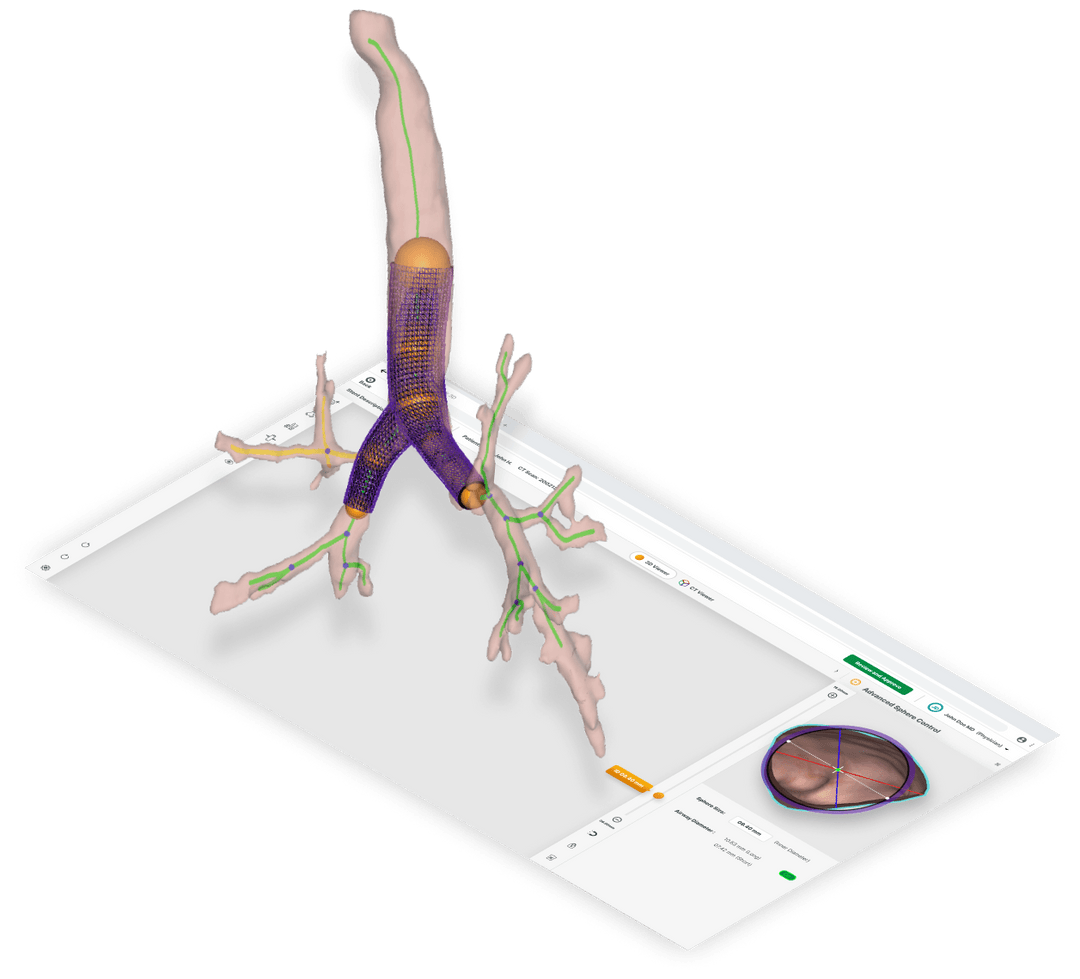 VisionAir Solutions - Patient-Specific Airway Stents