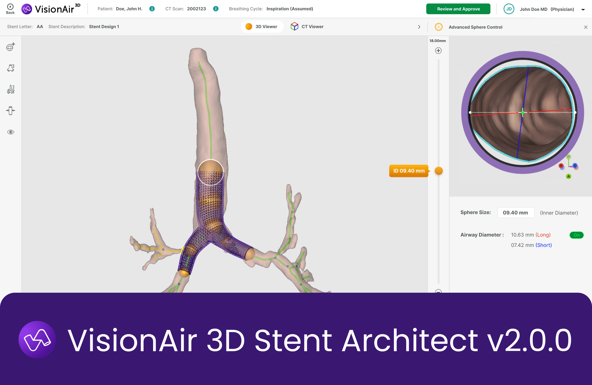 Patient-Specific Stents