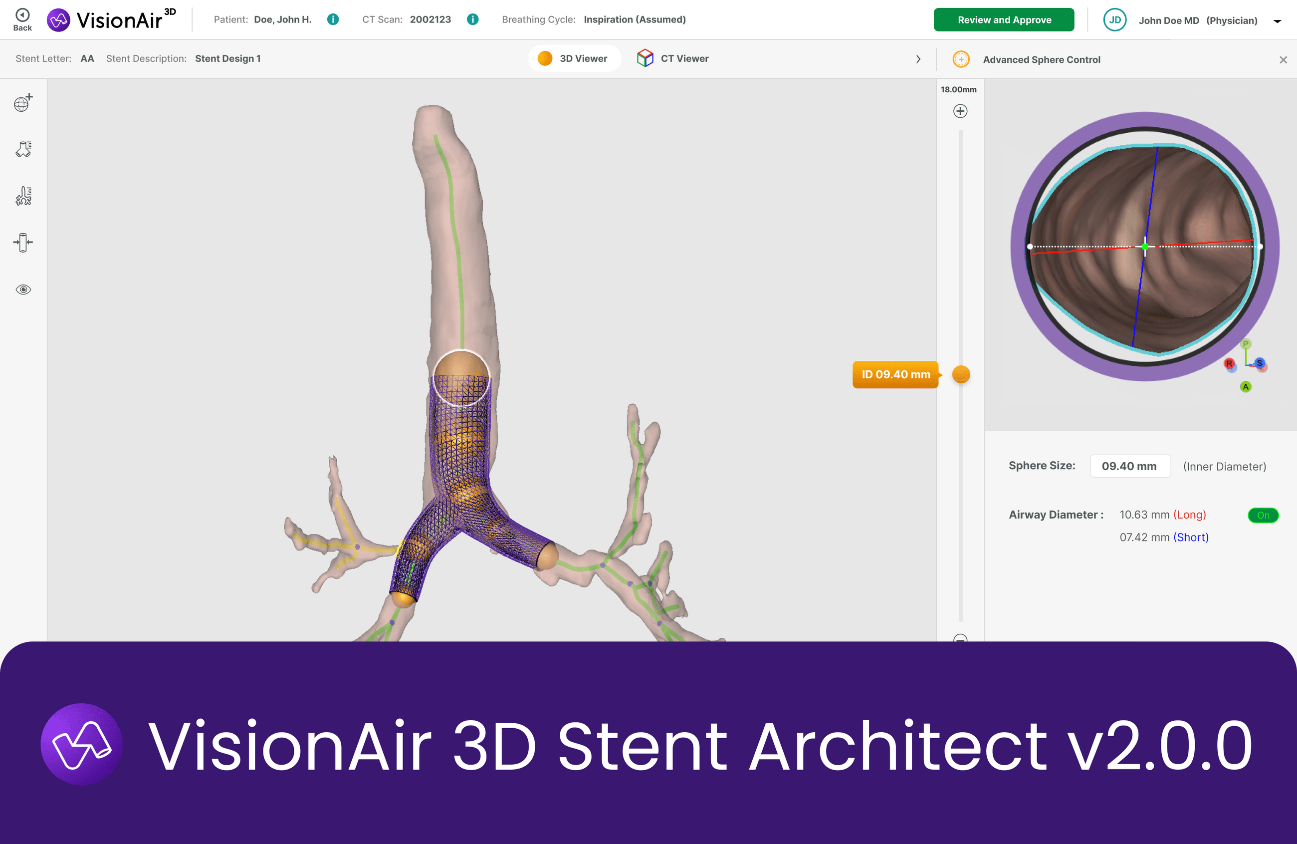 Patient-Specific Stents