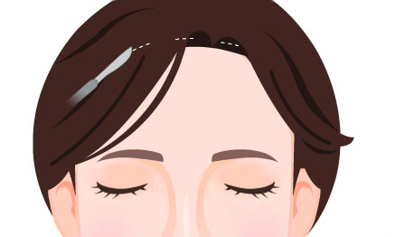 Eyebrow Bone Reduction • Endoscopic Facial Feminization