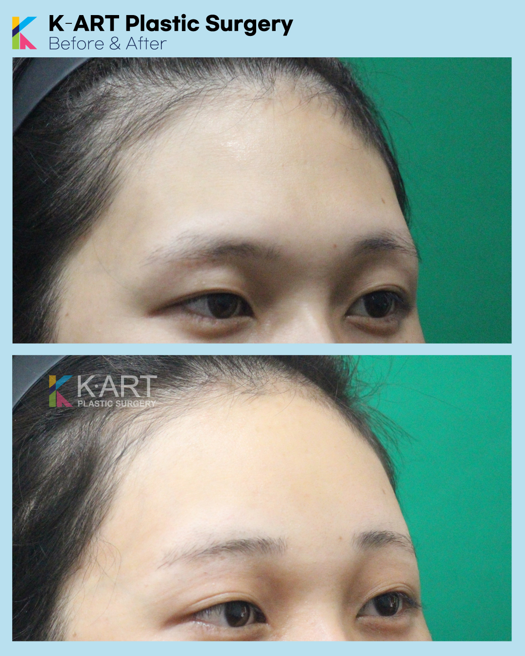 Eyebrow Bone Reduction • Endoscopic Facial Feminization