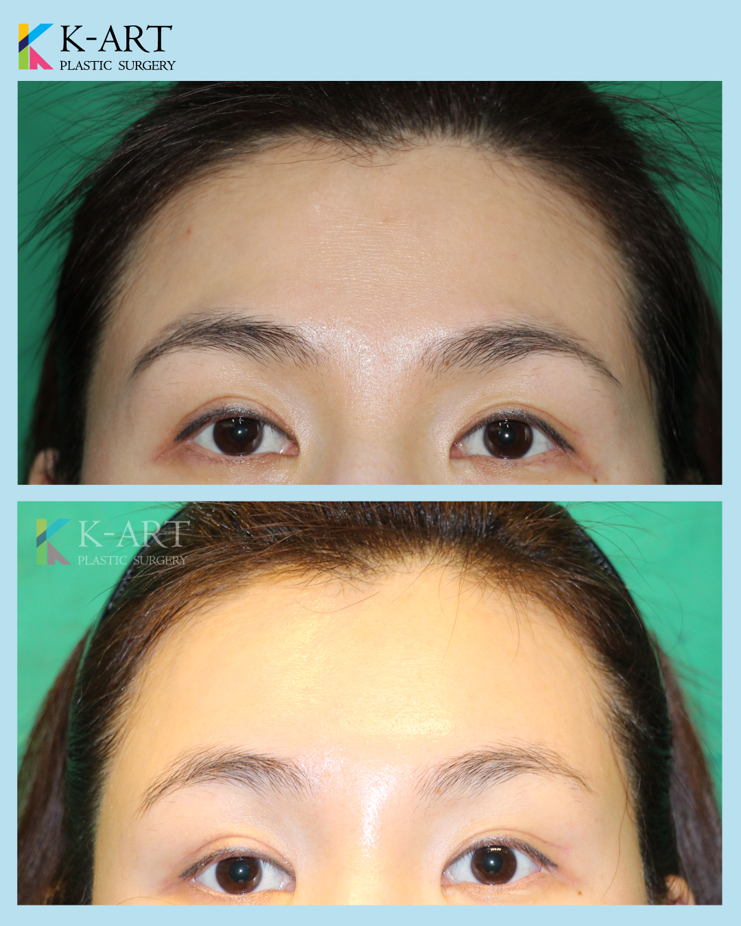 Art Volume Forehead • Endoscopic Facial Feminization