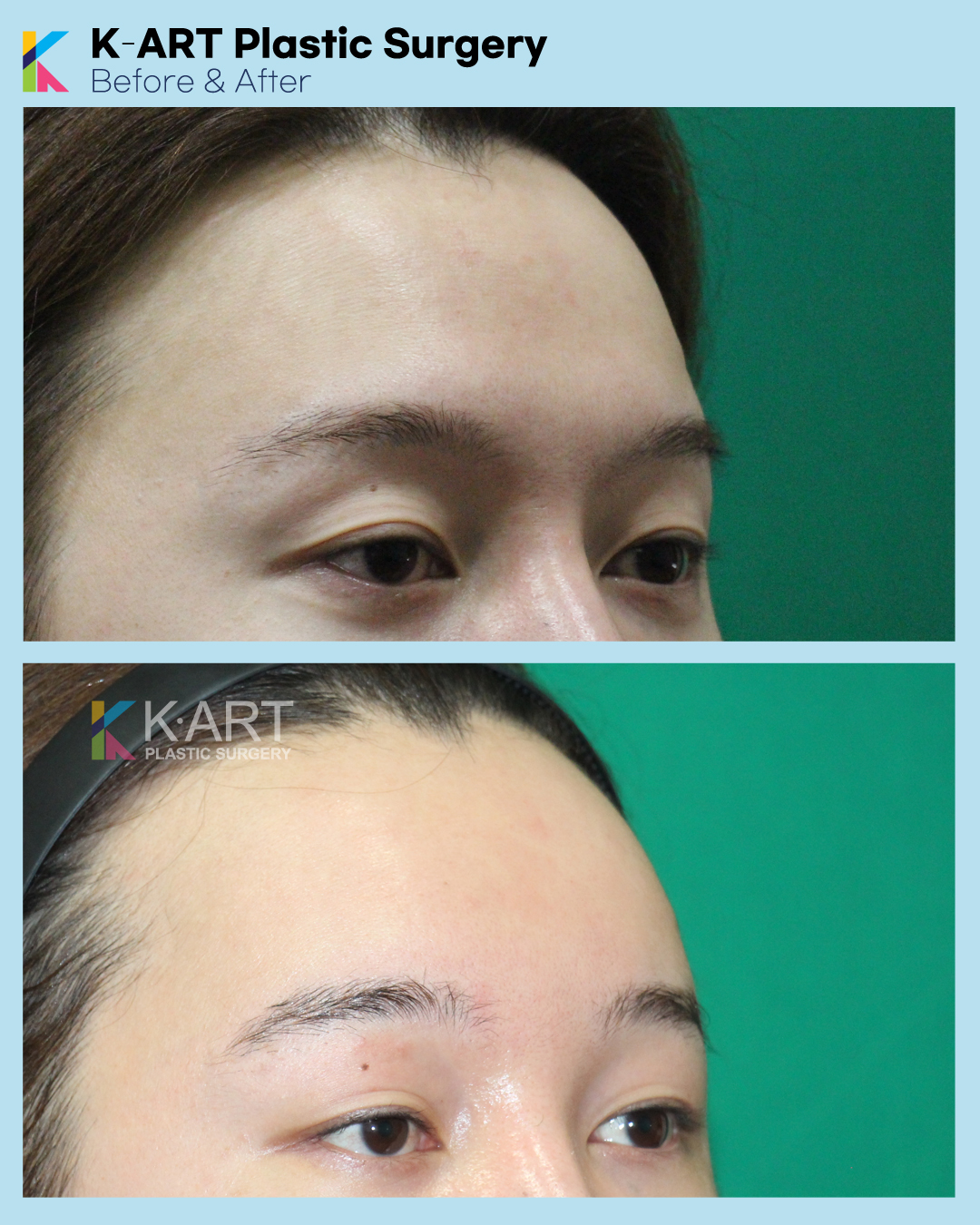 Eyebrow Bone Reduction • Endoscopic Facial Feminization