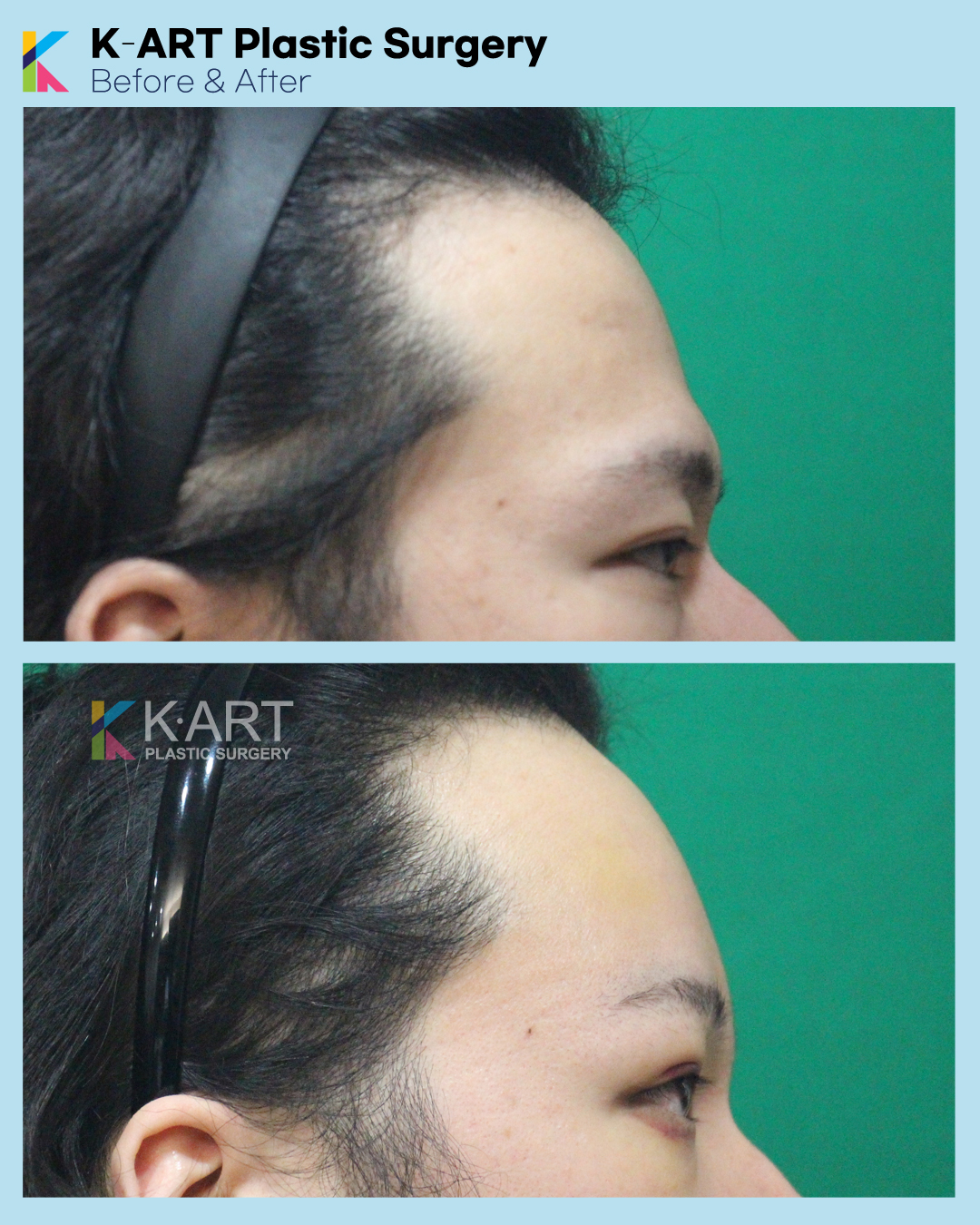 Eyebrow Bone Reduction • Endoscopic Facial Feminization