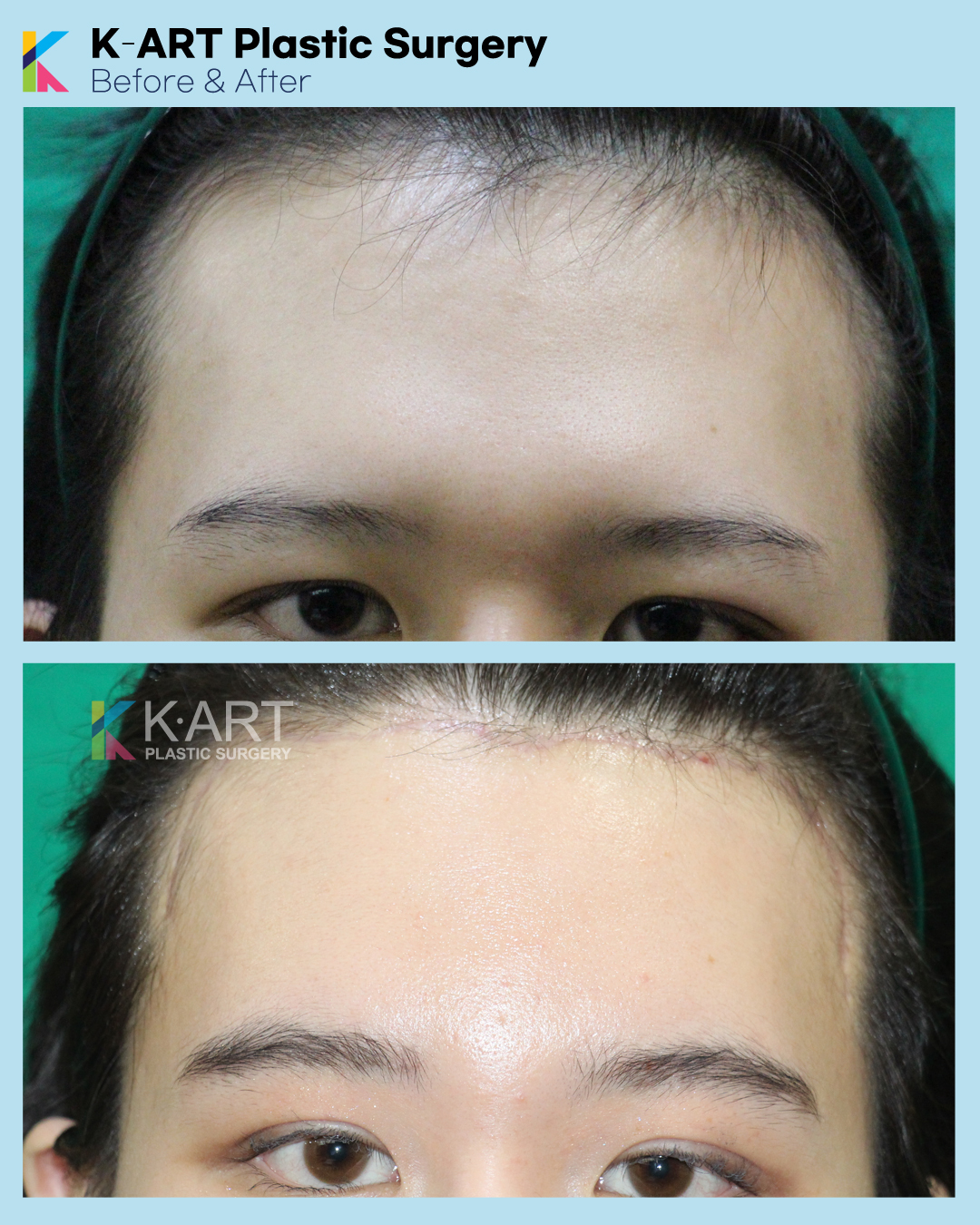 Eyebrow Bone Reduction • Endoscopic Facial Feminization