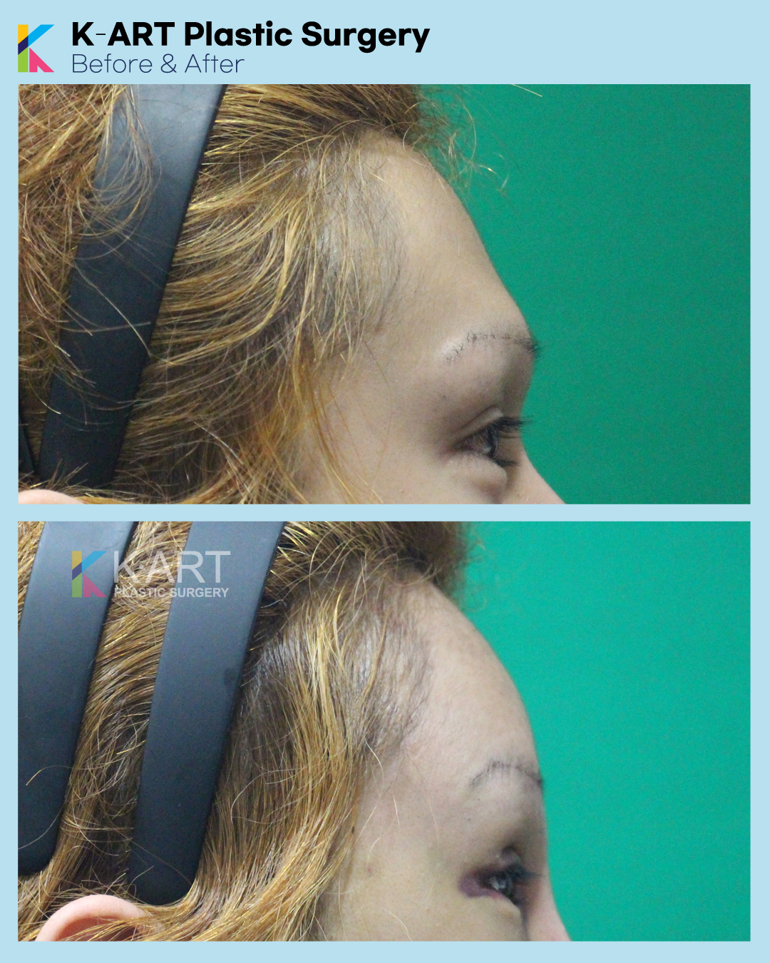 Eyebrow Bone Reduction • Endoscopic Facial Feminization