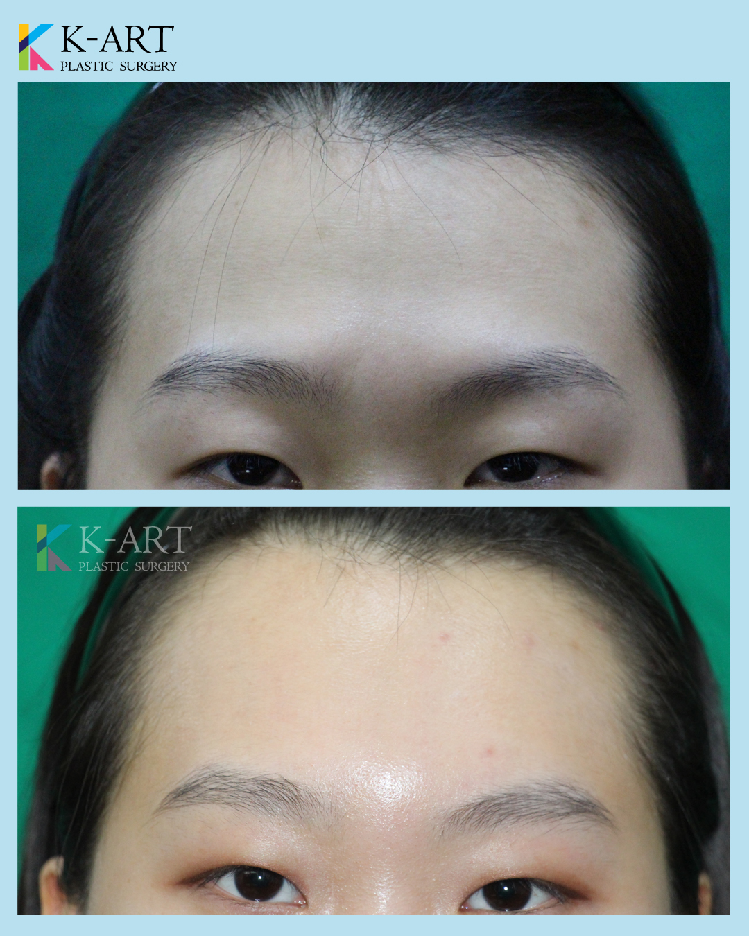 Eyebrow Bone Reduction • Endoscopic Facial Feminization
