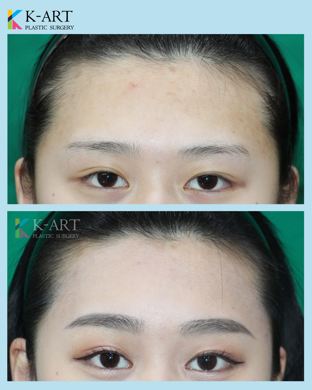 Art Volume Forehead • Endoscopic Facial Feminization