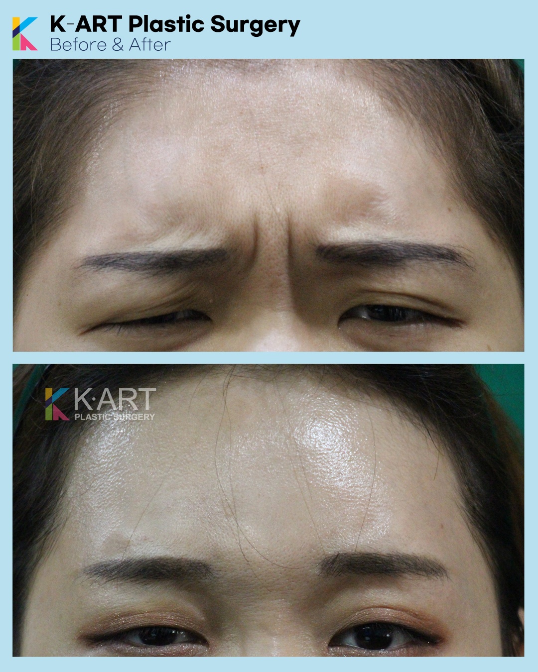 Forehead Brow Lifting • Endoscopic Facial Feminization