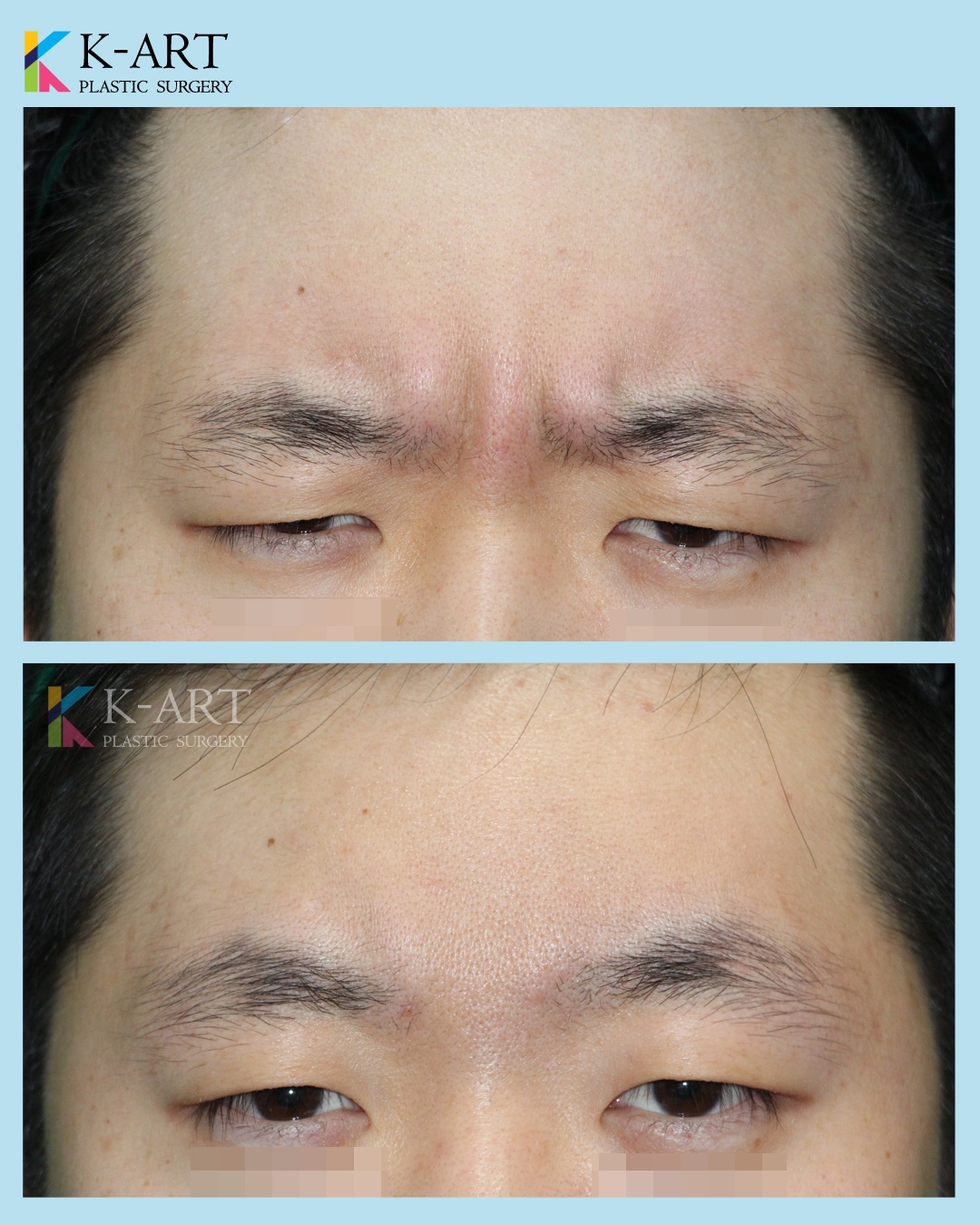 Forehead Brow Lifting • Endoscopic Facial Feminization