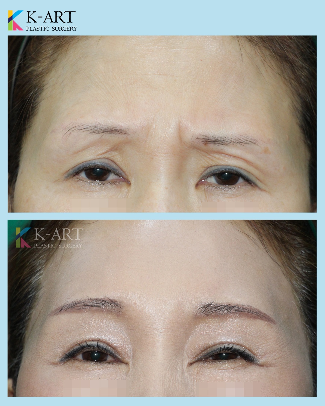Forehead Enlargement • Endoscopic Facial Feminization