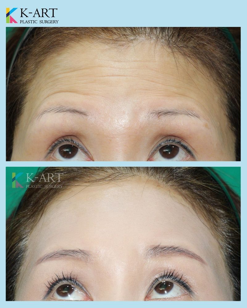Eyebrow Bone Reduction • Endoscopic Facial Feminization