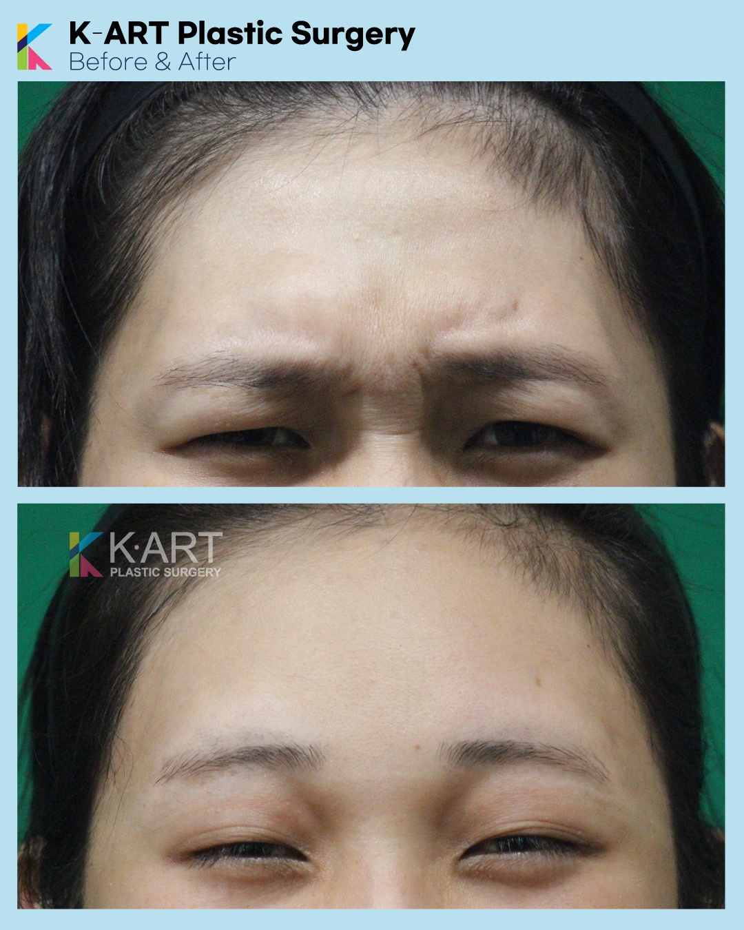 Forehead Brow Lifting • Endoscopic Facial Feminization
