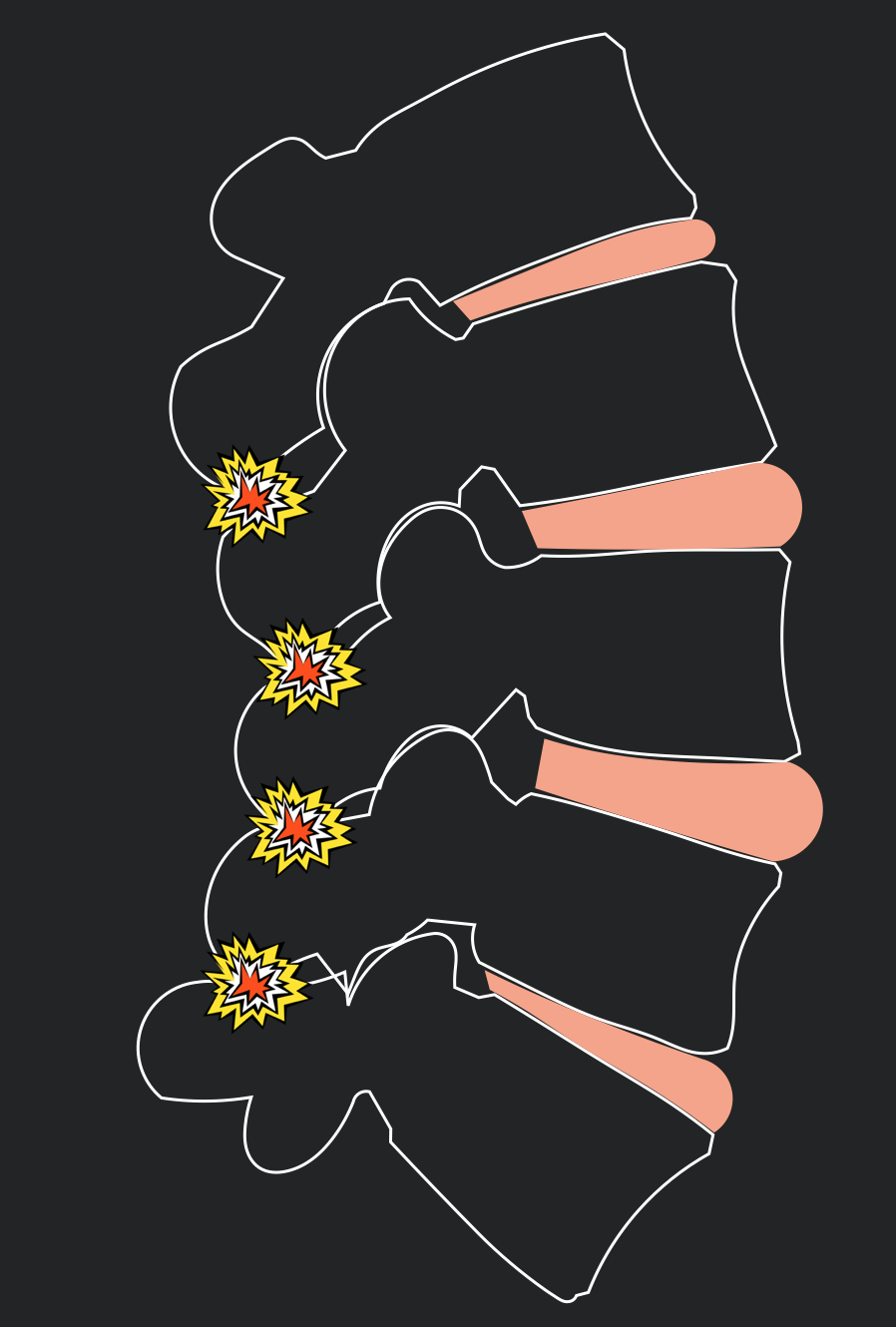 Biomechanics of the spine - posture, forces and structures | Core Advantage