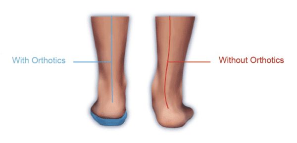 What are orthotics and when do I need them? | Hyperhealth