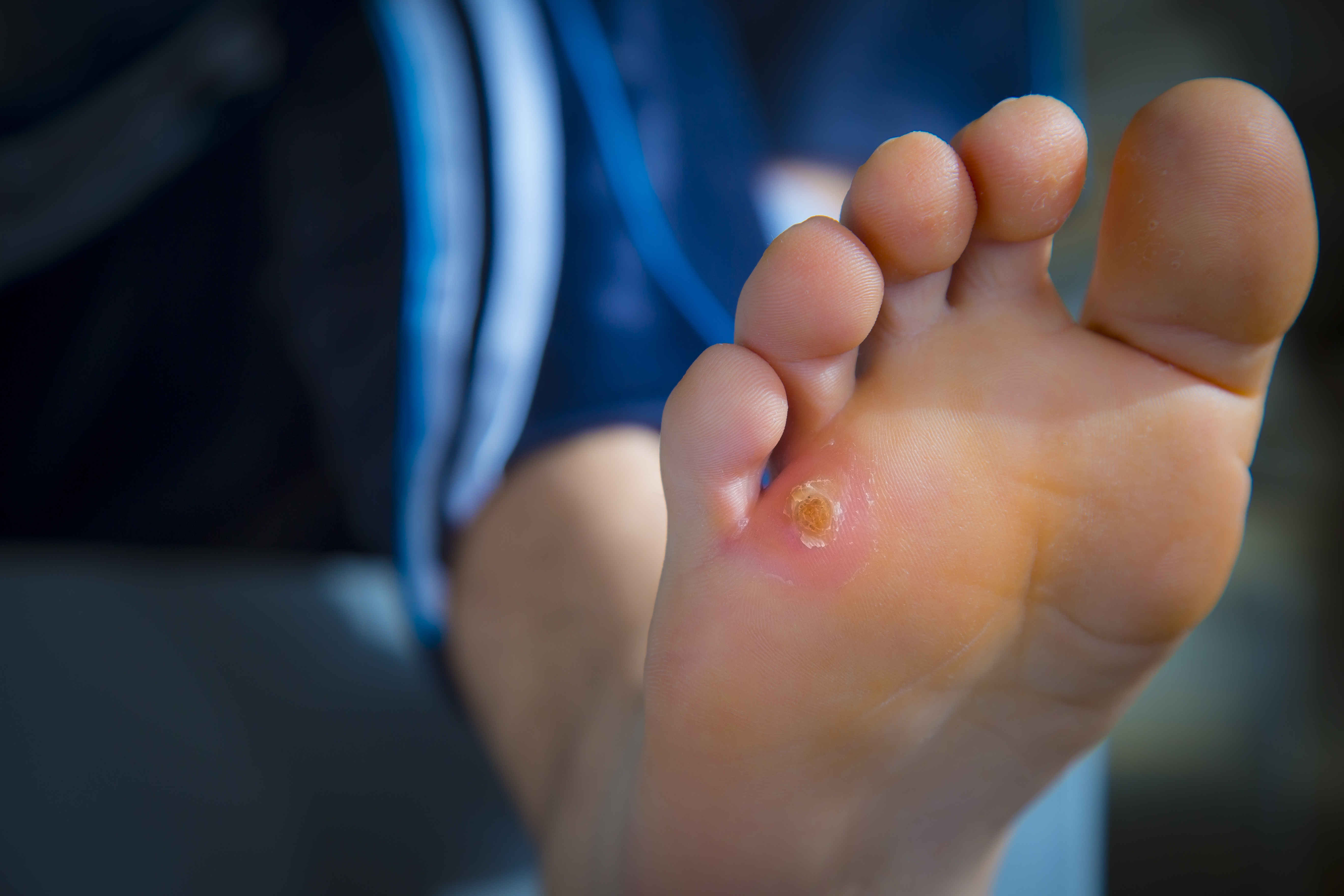 Corns and Calluses on the Feet - 4 Easy Ways on How to Prevent Them ...