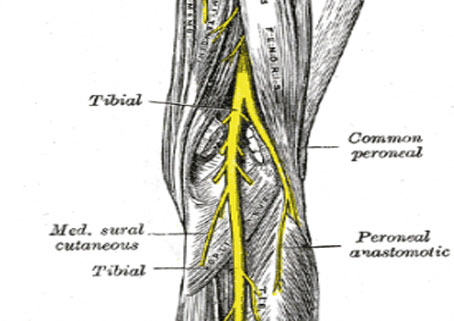 Radicular Pain - Sciatica | Hyperhealth